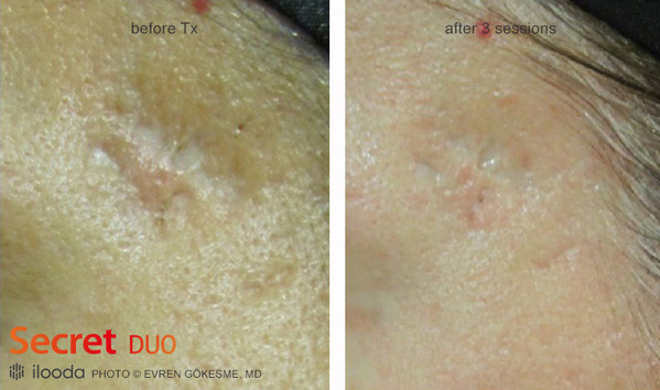 ilooda's Medical Device Wins FDA Approval for Treating Scars After ...