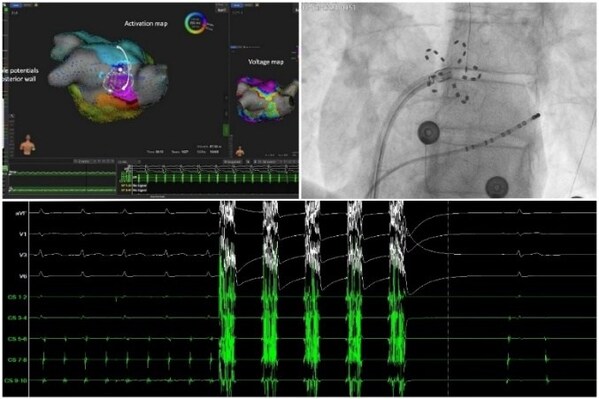 波士顿科学FARAPULSE系列产品在第35届长城心脏病学大会上市发布