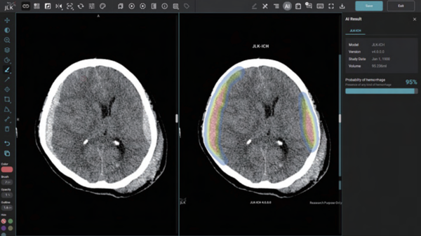 제이엘케이, JLK-ICH(두개내출혈 검출 솔루션) 美 FDA 획득